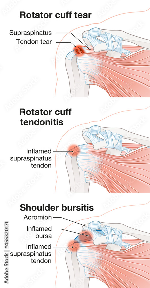 Shoulder pain. Rotator cuff tear, rotator cuff tendonitis, shoulder ...