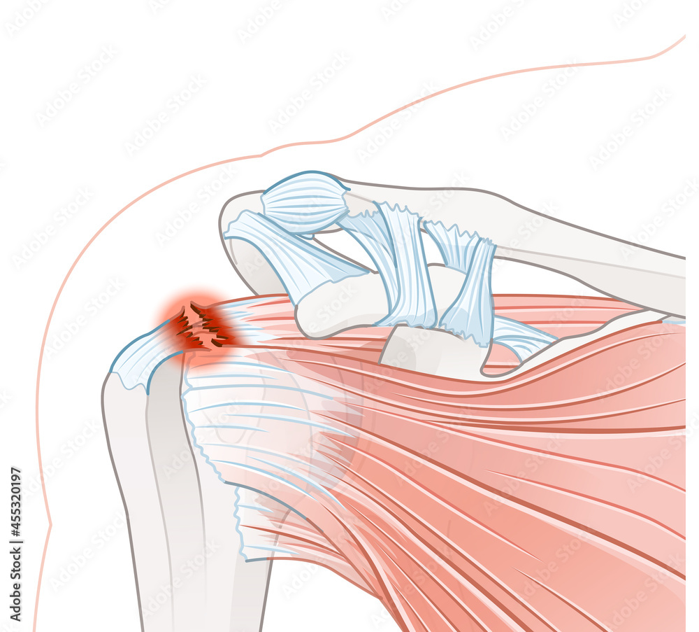 Shoulder pain. Rotator cuff tear ilustração do Stock | Adobe Stock