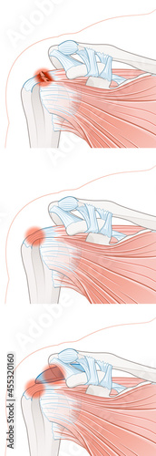 Shoulder pain. Rotator cuff tear, rotator cuff tendonitis, shoulder ...