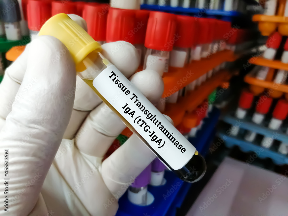 Blood Sample for Tissue transglutaminase antibody (tTG) IgA, diagnosis ...