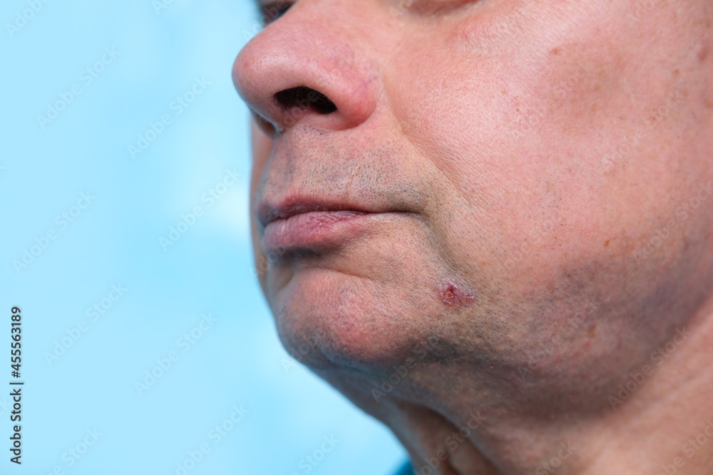 Foto de man with a herpes wound on the chin, viral skin rashes with ...