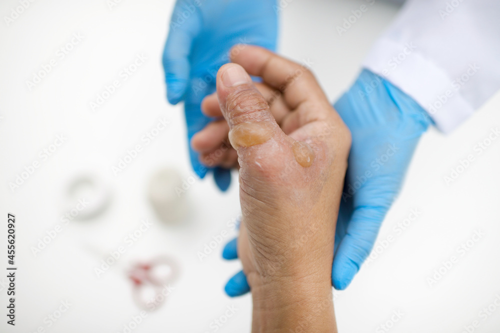 First aid treatment in patient with burn injury on hand and thumb ...