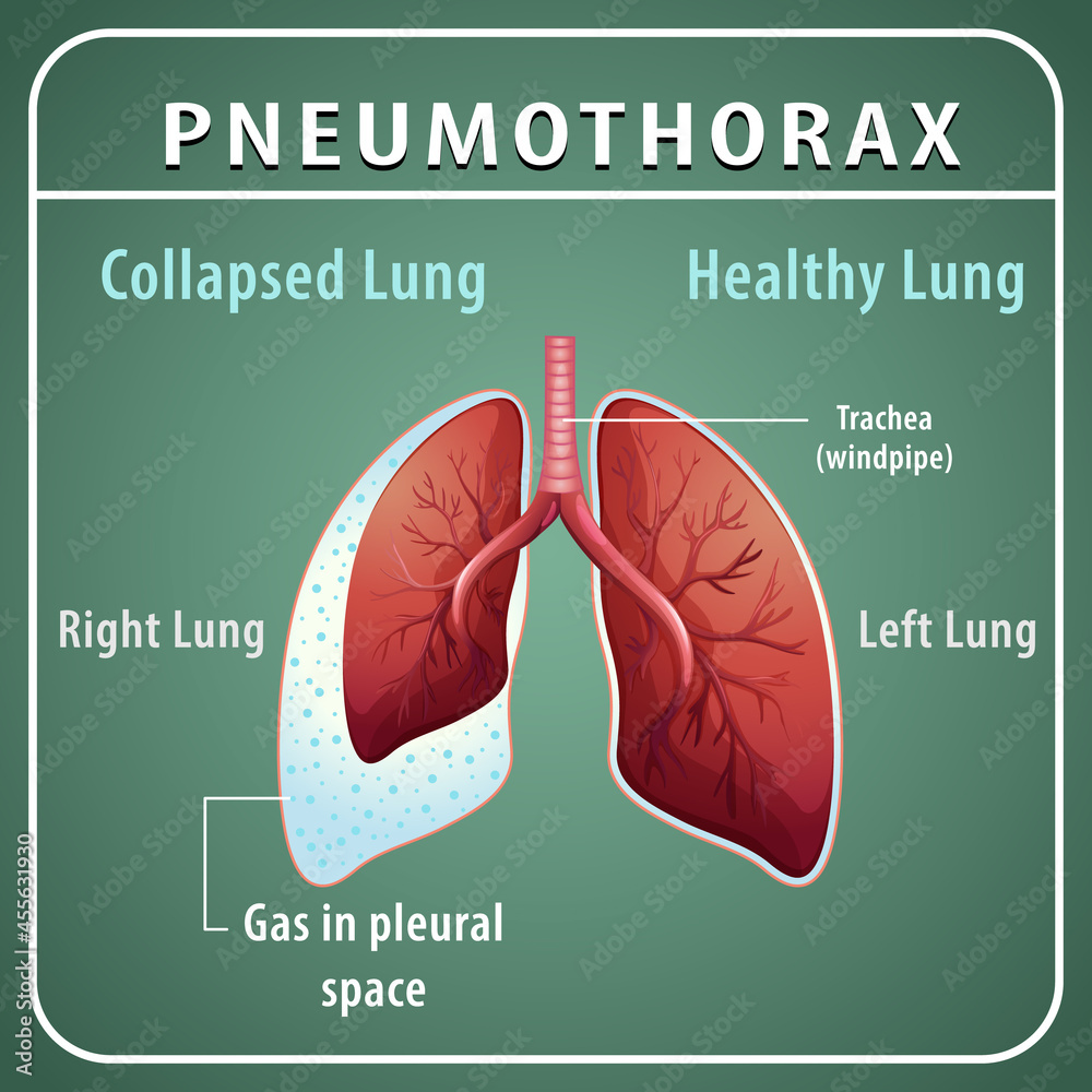 Vetor de Pneumothorax diagram with collapsed lung and healthy lung do ...