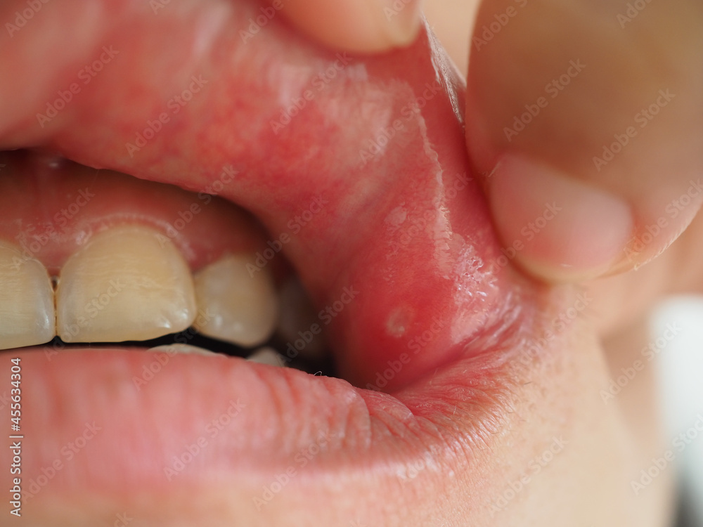 Herpes Lips Corner