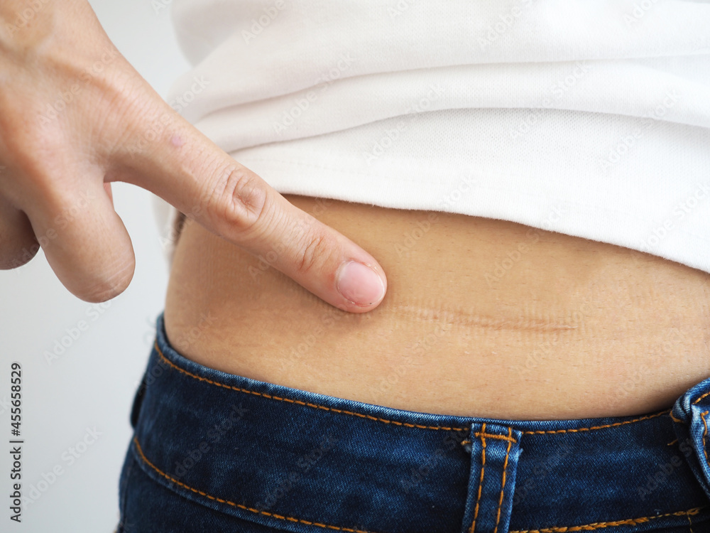 Scar on woman's stomach from appendectomy. Stock Photo | Adobe Stock