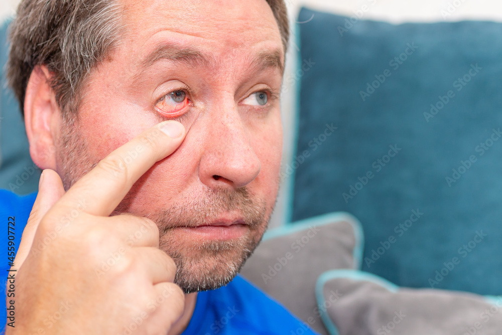 Broken blood vessel in eye. Man with the Subconjunctival hemorrhage ...