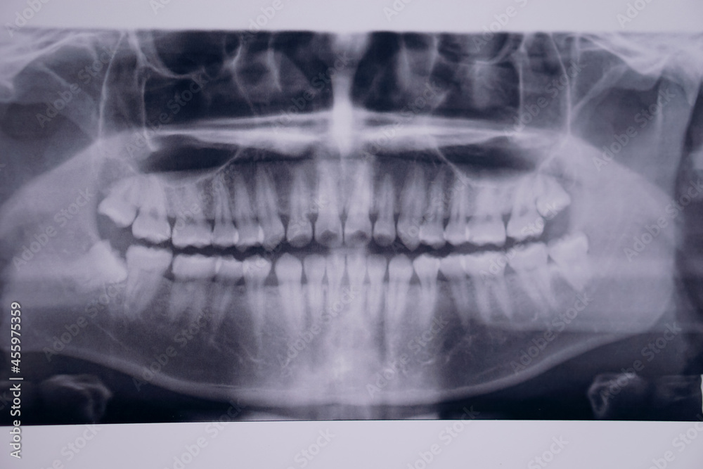 X ray dental tooth X-ray of a 17 year old teenage male teeth bones to ...