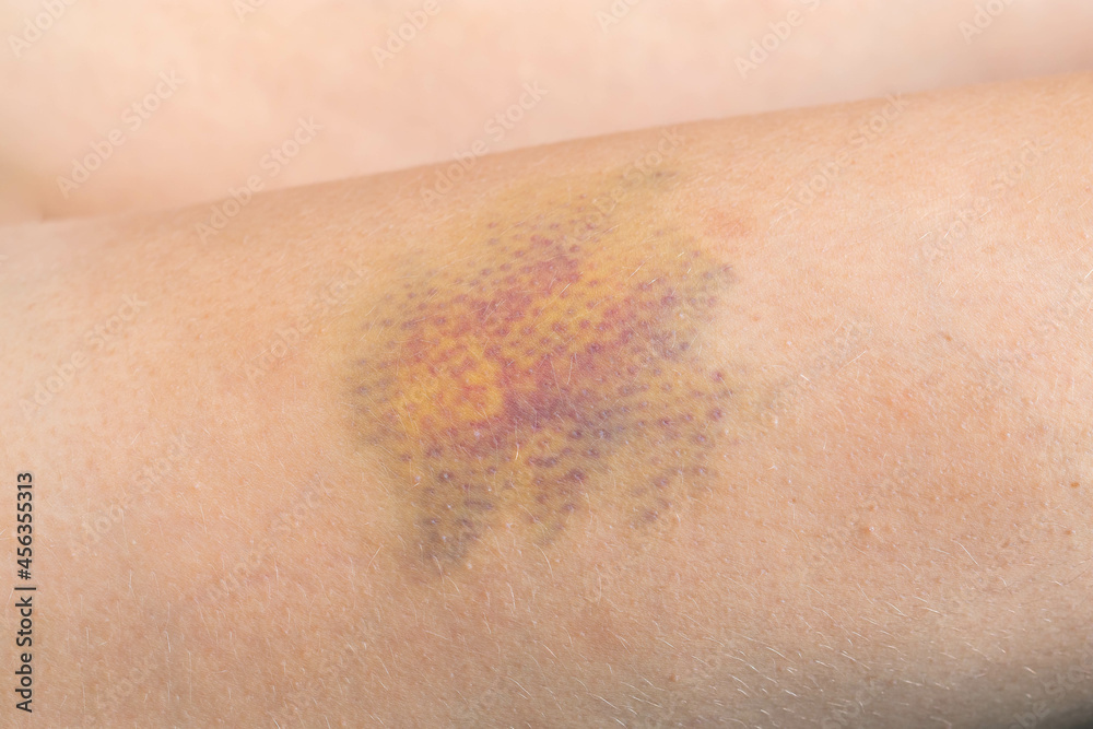 Hematoma on the leg. Large hematoma, close-up shot. Stock Photo | Adobe ...