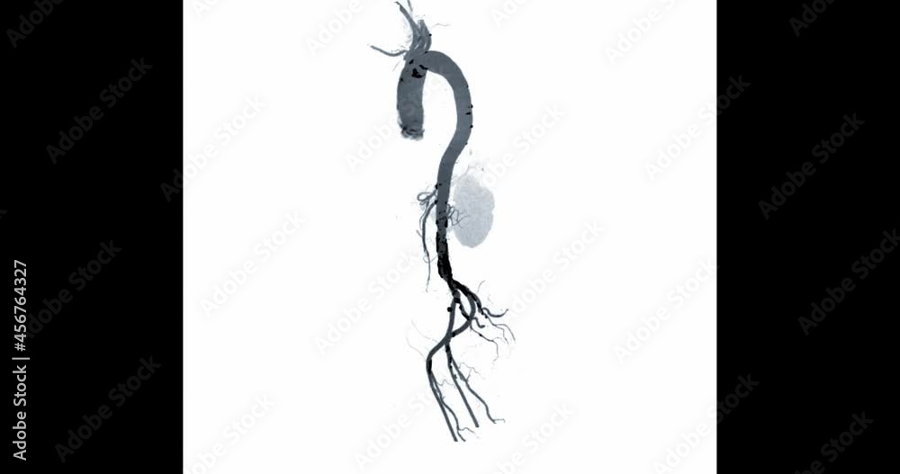 CTA whole aorta angiography filter view turn around the screen for ...