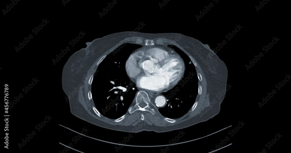 CTA whole aorta axial view for diagnosis aortic aneurysm. Stock Video ...