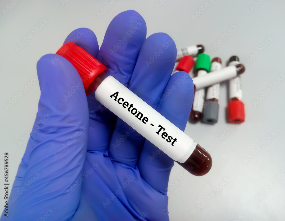 Blood sample for acetone test, diabetic ketoacidosis or alcoholic ...