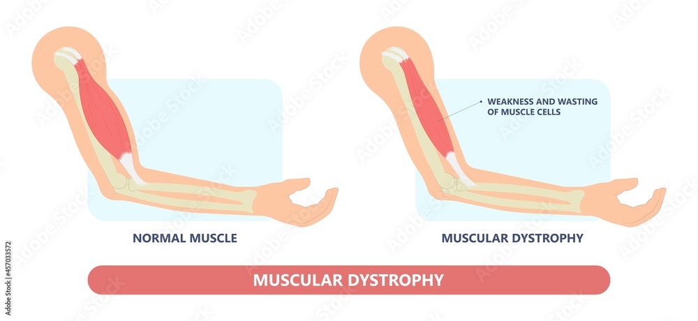 Muscle myopathy gene DNA cell damage Becker type Limb Girdle x linked ...