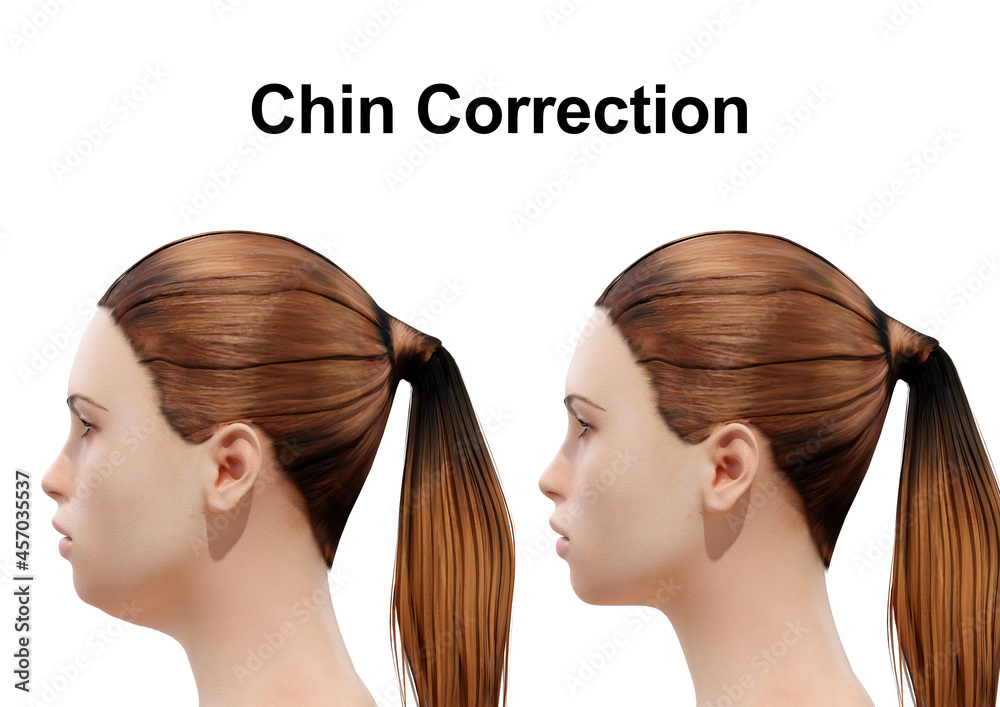 ภาพประกอบสต็อก Chin correction plastic surgery on young woman before ...