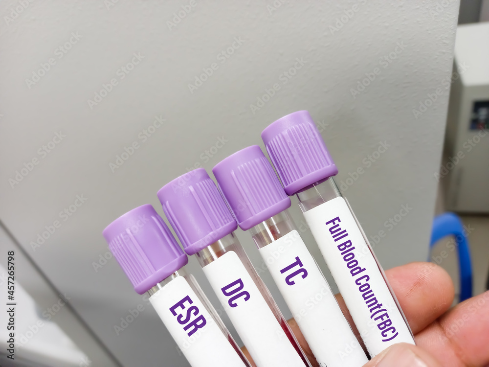 Blood sample tube for Full Blood Count(FBC). CBC, Hemoglobin, ESR Stock ...