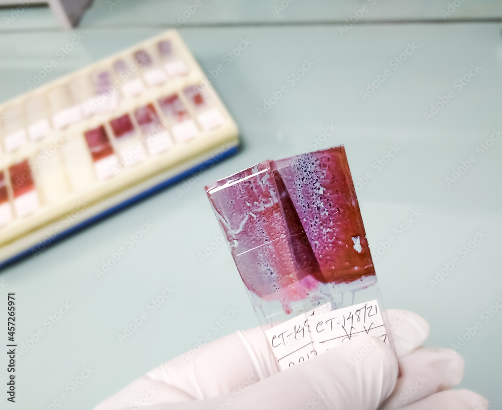 Close view of Cytopathology slides stained with Pap's stain, displayed ...