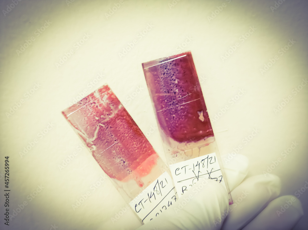 Close view of Cytopathology slides stained with Pap's stain, displayed ...