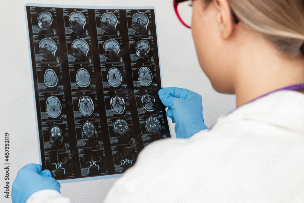 MRI scan of brain by computer tomography in the doctor's hands. A young ...