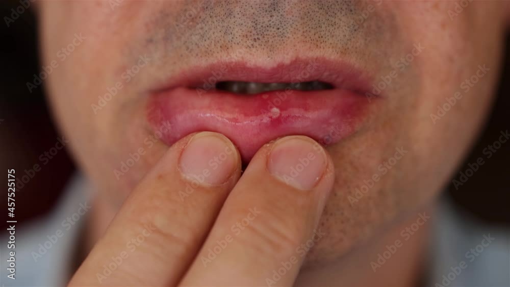 recurrent aphthous ulcers or canker sores, sore lip. Aphthous ... recurrent aphthous ulcers or canker sores, sore lip. Aphthous ...