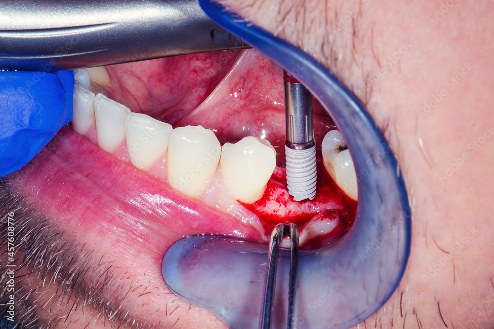 Opened mandibular bone after surgical incision of the gums with a ...