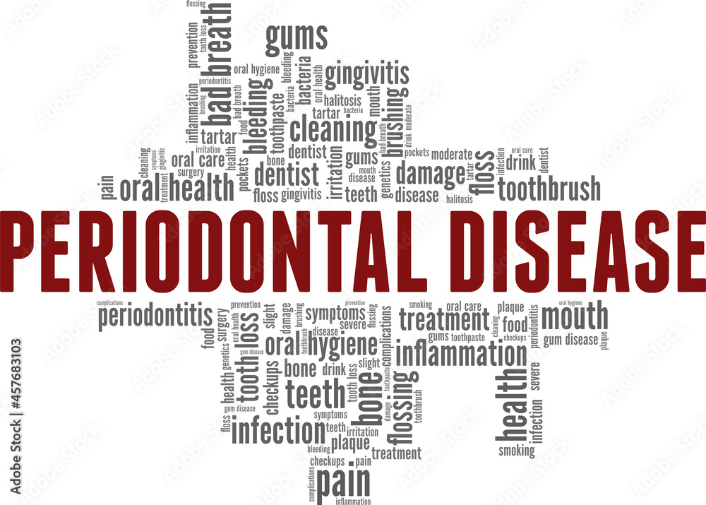 Periodontitis - Periodontal Disease vector illustration word cloud ...