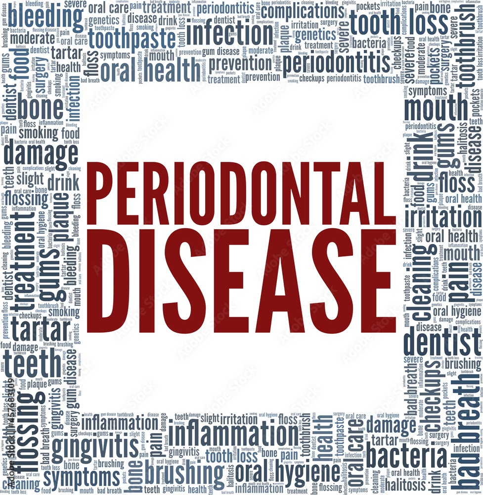 Periodontitis - Periodontal Disease vector illustration word cloud ...