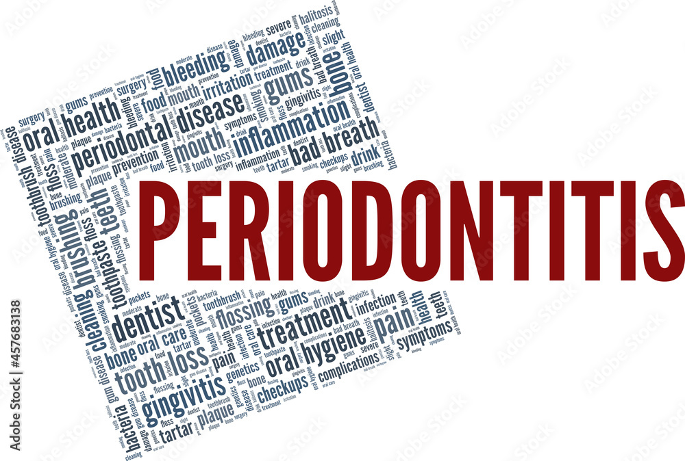 Periodontitis - Periodontal Disease vector illustration word cloud ...