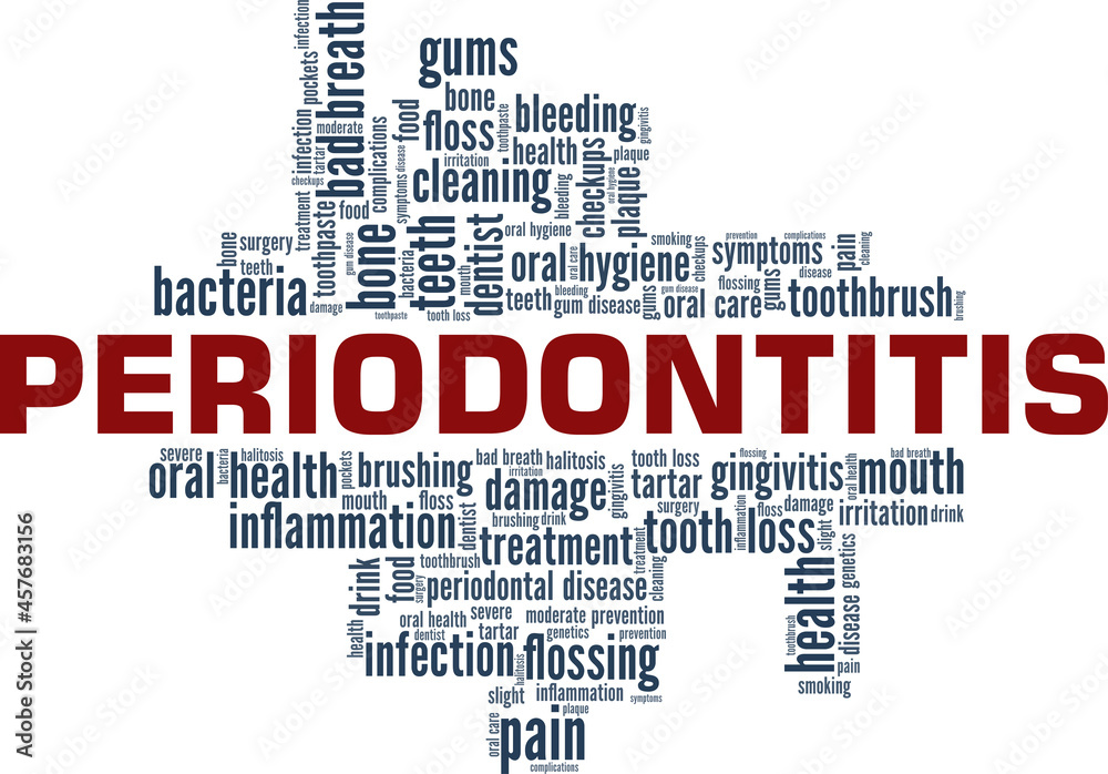 Periodontitis - Periodontal Disease vector illustration word cloud ...