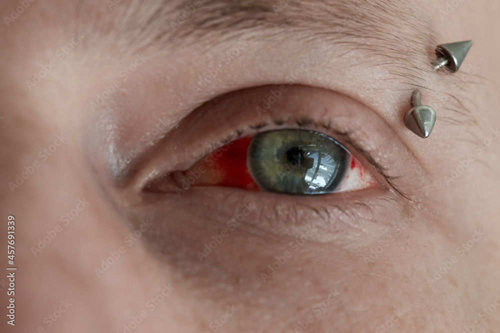Close-up of a male human eye with broken blood vessels (Subconjunctival ...