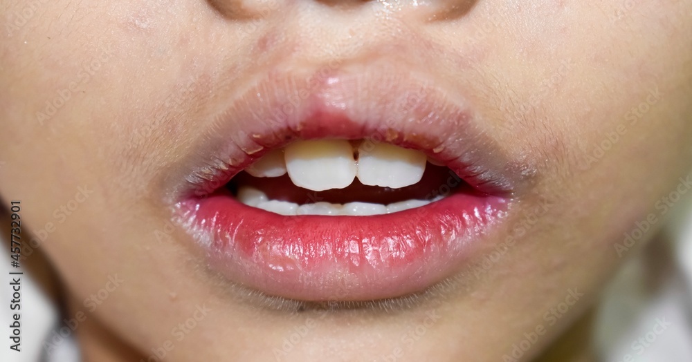 Angular Stomatitis