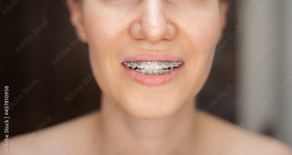 The smile of a young and beautiful girl with braces on her white teeth ...