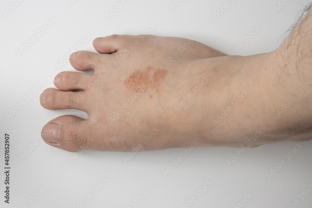 Top view of foot infected with ringworm, athlete's foot or tinea pedis ...