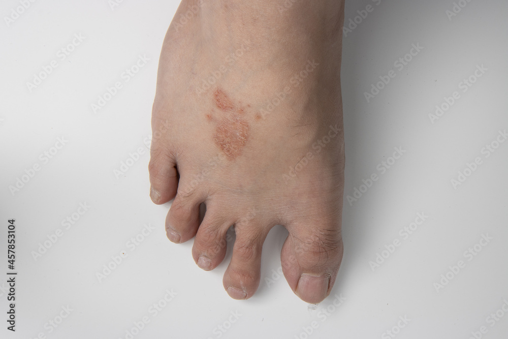 close up of foot infected with ringworm, athlete's foot or tinea pedis ...