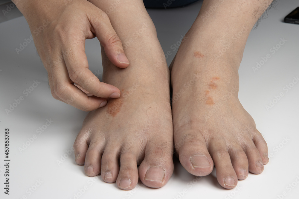 hand scratching foot infected by ringworm, athlete's foot or tinea ...