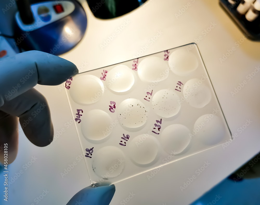 RPR, VDRL, Syphilis test glass slide agglutination method, showing ...
