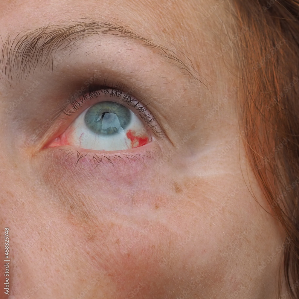 Fotografia do Stock: Subconjunctival hemorrhage or subconjunctival ...