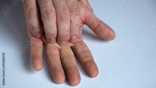 Painful rash, red spots blisters on the hand. Close up Allergy rash ...