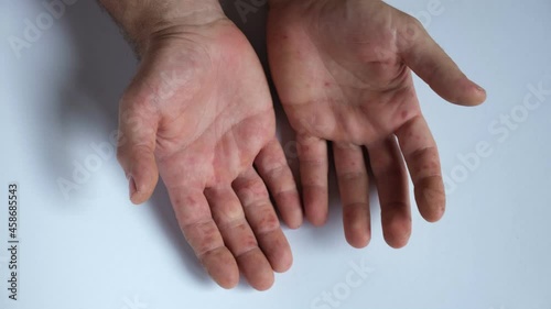 Painful rash, red spots blisters on the hand. Close up Allergy rash ...