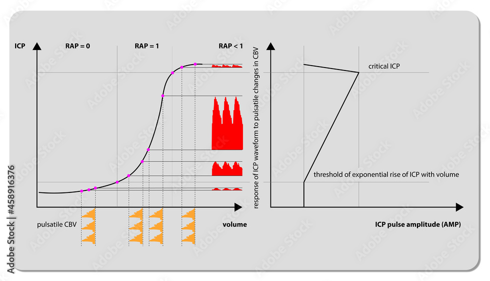 Intracranial Pressure Monitoring Icp Waveform 3d Render 2d Graphic Stock Illustration Adobe