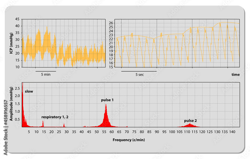 Intracranial Pressure Monitoring Icp Waveform 3d Render 2d Graphic Stock Illustration Adobe