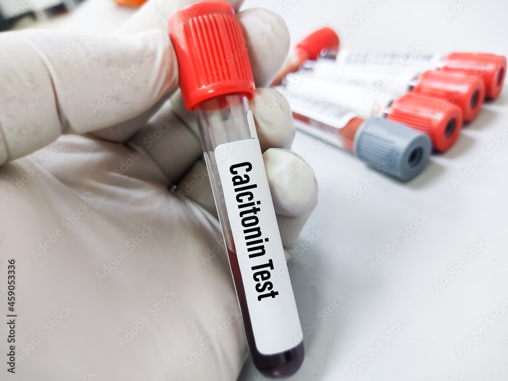 Blood sample of Calcitonin Test for medullary thyroid cancer Stock ...
