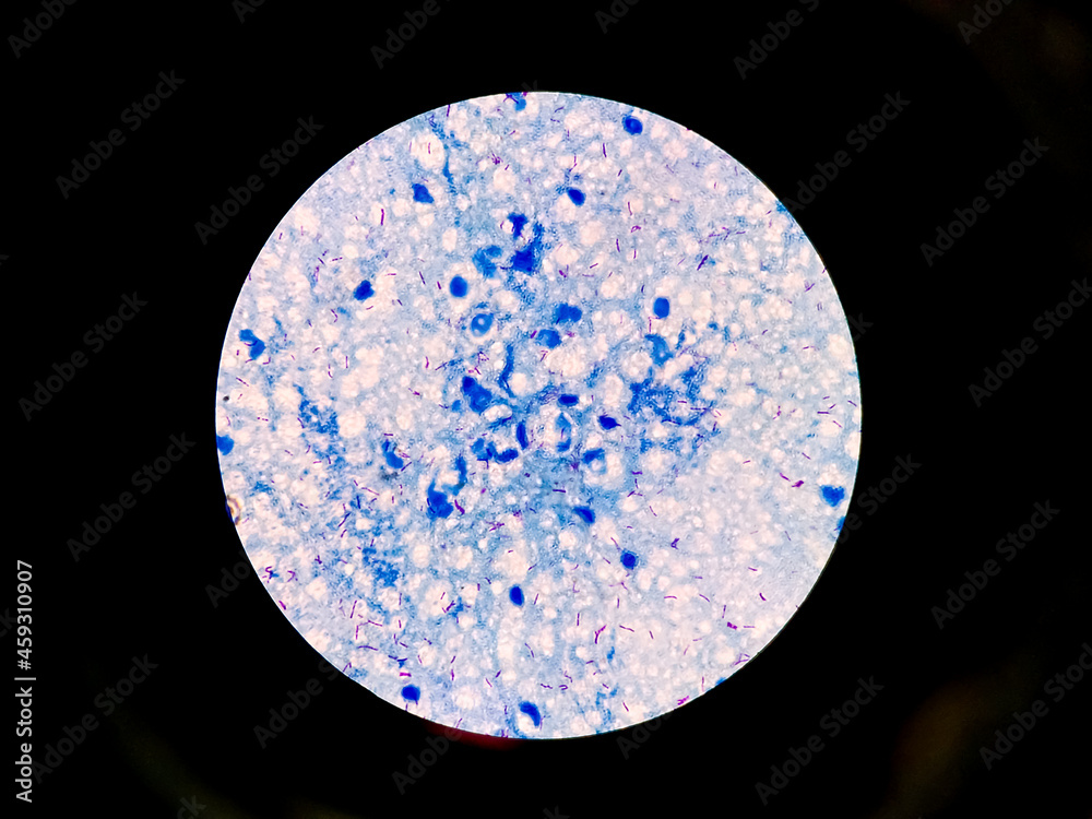 Pulmonary Tuberculosis ( TB ) : Sputum AFB stain microscopic image. To ... Pulmonary Tuberculosis ( TB ) : Sputum AFB stain microscopic image. To ...