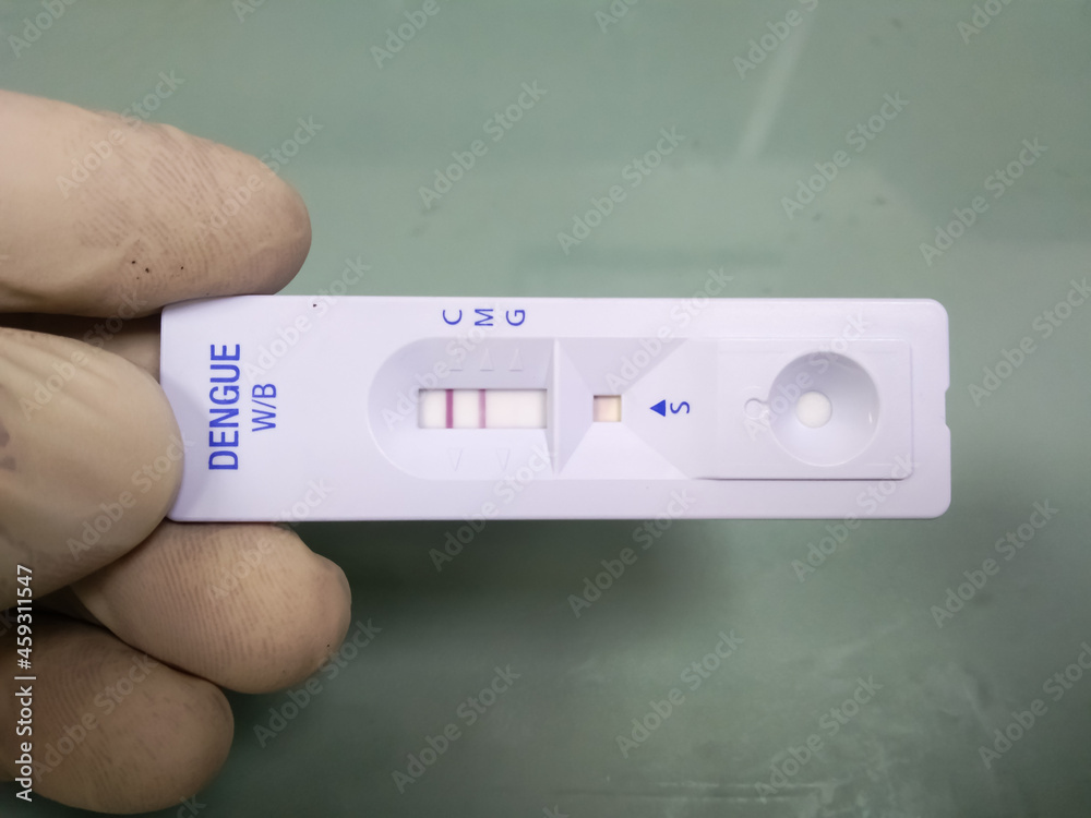 Rapid test cassete for Dengue antibody IgG, IgM test. Showing result ...