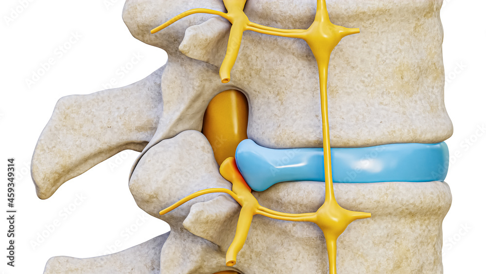 Herniated disc with spinal nerve compression 3D rendering illustration ...