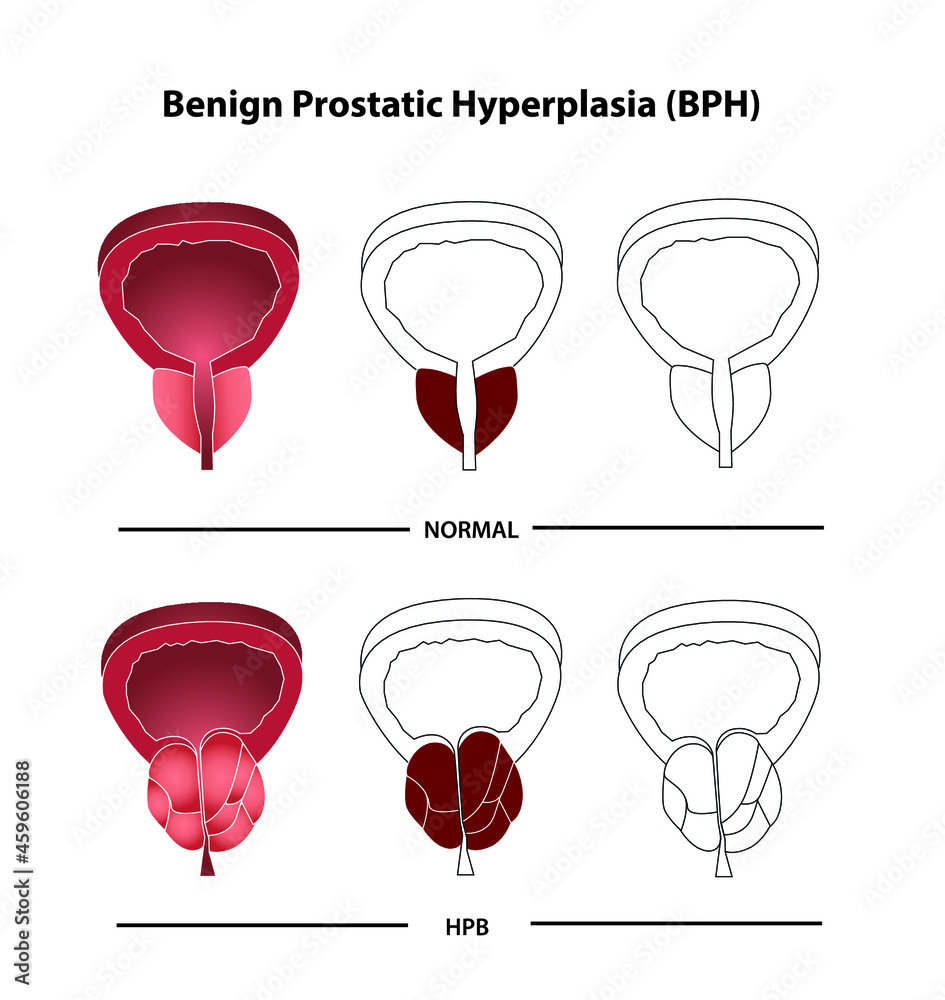 Benign prostatic hyperplasia. Hiperplasia prostática benigna Stock ...