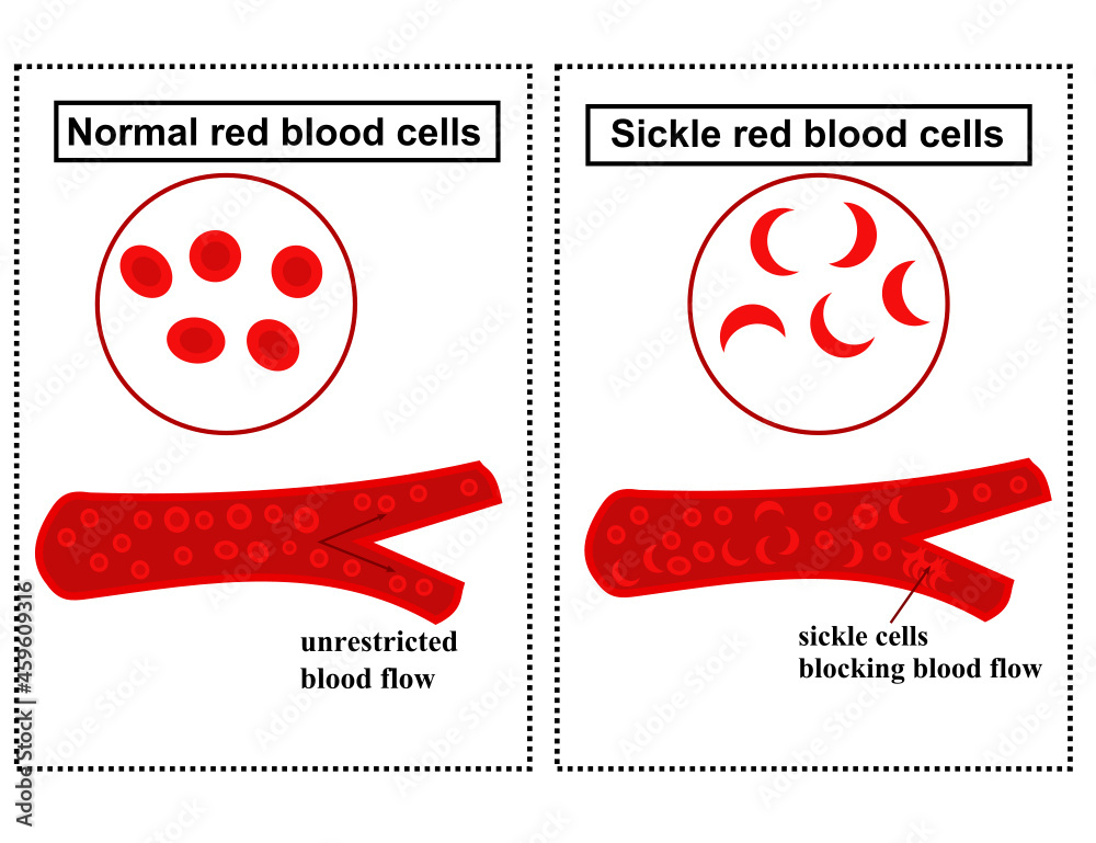 Normal red blood cell and sickle cell.Anaemia disease.Diagram or ... Normal red blood cell and sickle cell.Anaemia disease.Diagram or ...