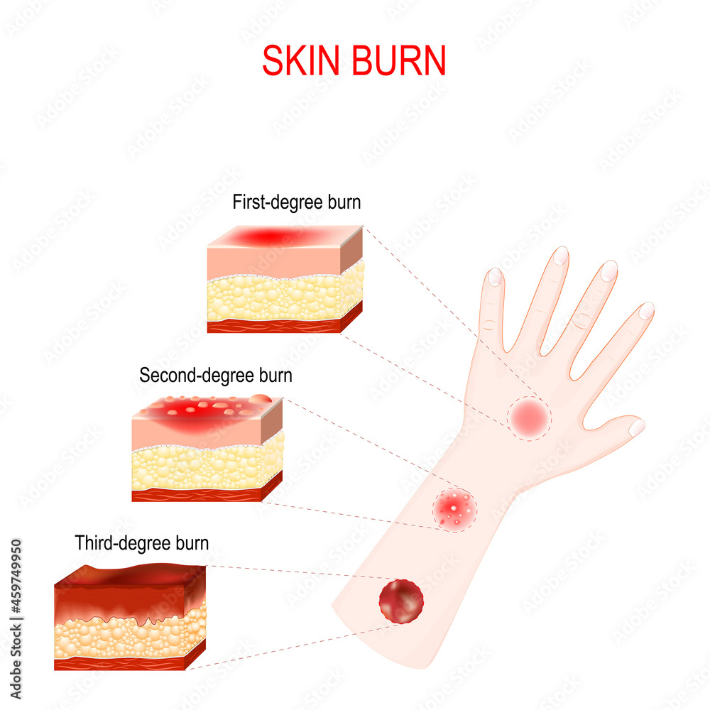 types of burns. Cross section of humans skin Stock Vector | Adobe Stock