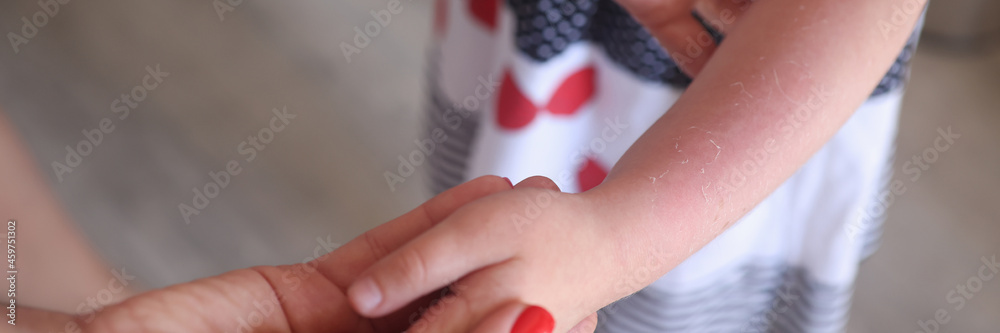 Sunburn redness and peeling of skin on child hand closeup Stock Photo ...