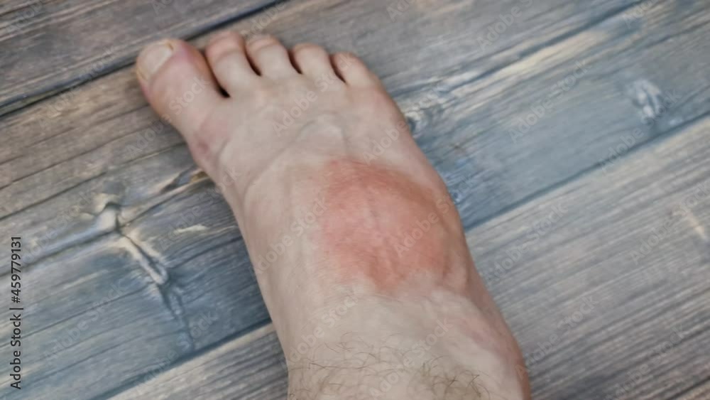 The Foot disease. Foot skin disease. Skin disease. Stock Video | Adobe ...