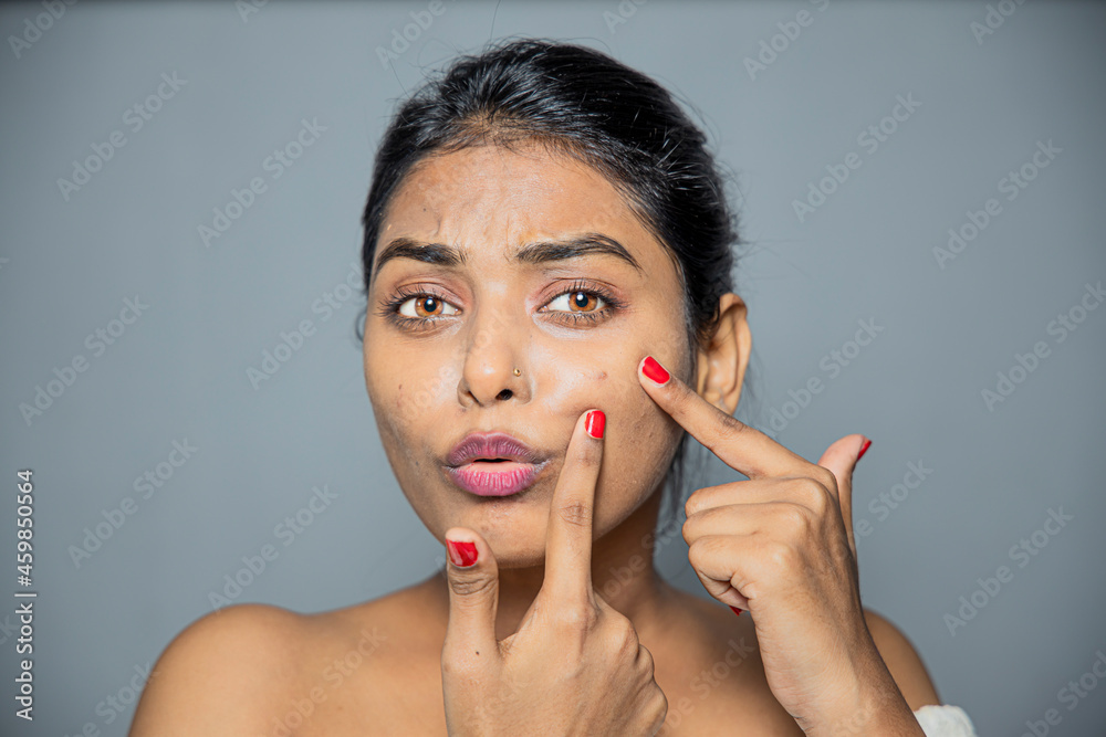 Indian Young lady squeezing her pimples, removing pimple from her face ...