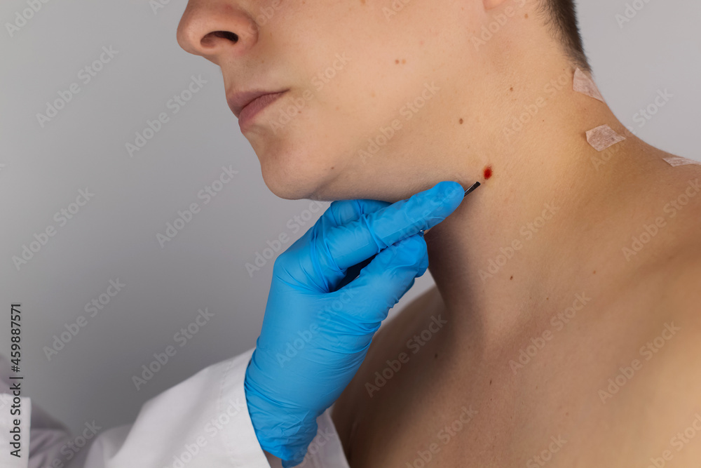 Close-up of the wound that remained after excision of the nevus ...